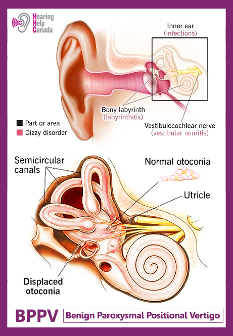 Dizziness and Vertigo - HearingHelpCanada