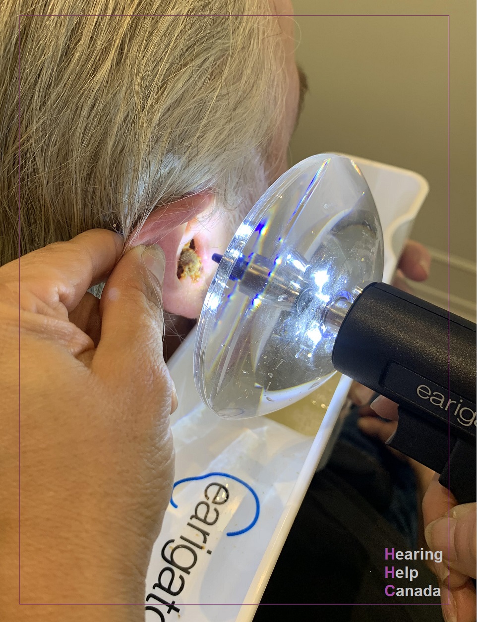 Cerumen Management by Irrigation - HearingHelpCanada